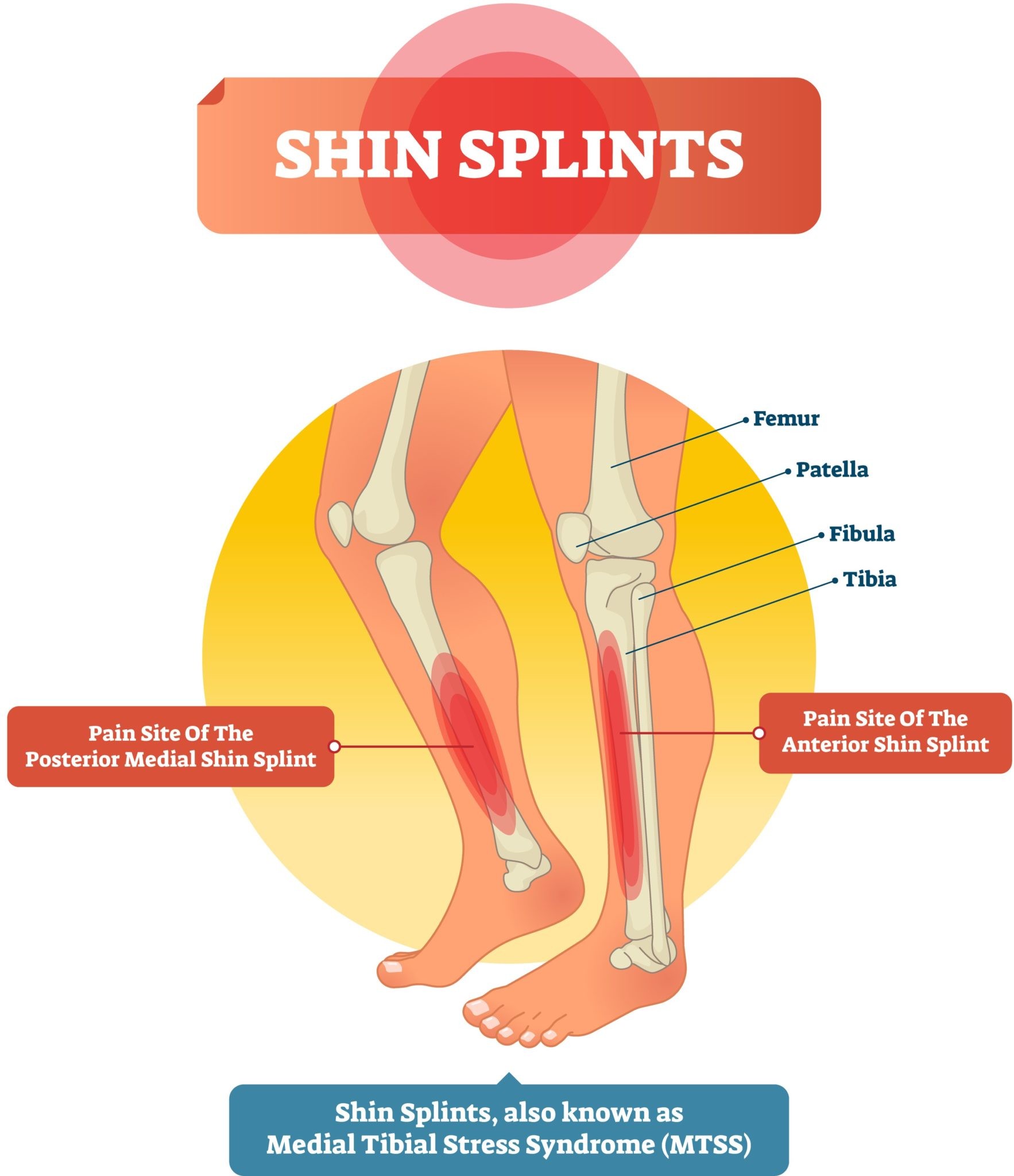 VA Disability Ratings for Shin Splints Explained | CCK Law