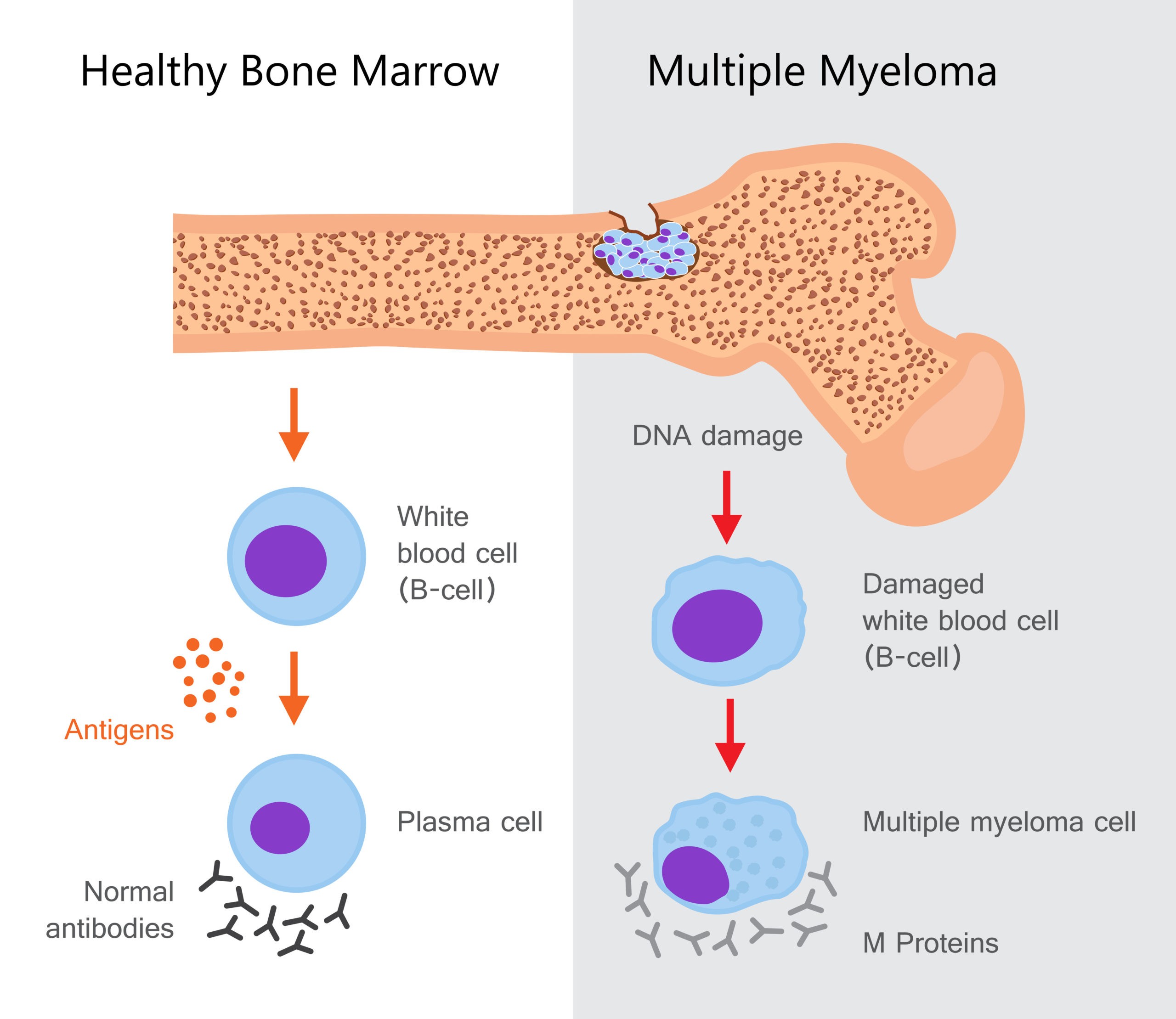 What Is End Stage Multiple Myeloma Like Loria Mccain
